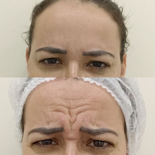 Kattransforma Antes e Depois de Harmonização Facial e Corporal ...