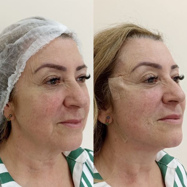Kattransforma Antes e Depois de Harmonização Facial e Corporal ...