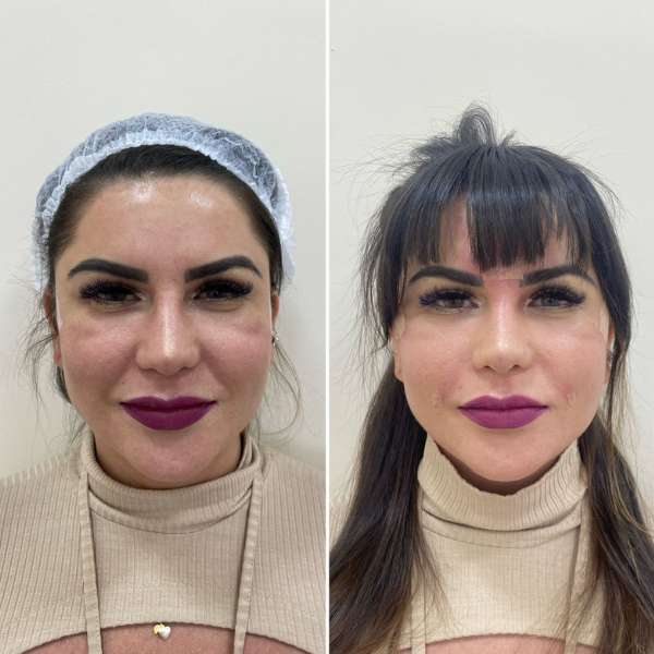 Kattransforma Antes e Depois de Harmonização Facial e Corporal ...