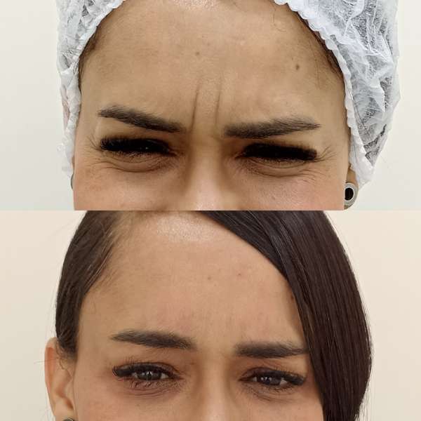 Kattransforma Antes e Depois de Harmonização Facial e Corporal ...